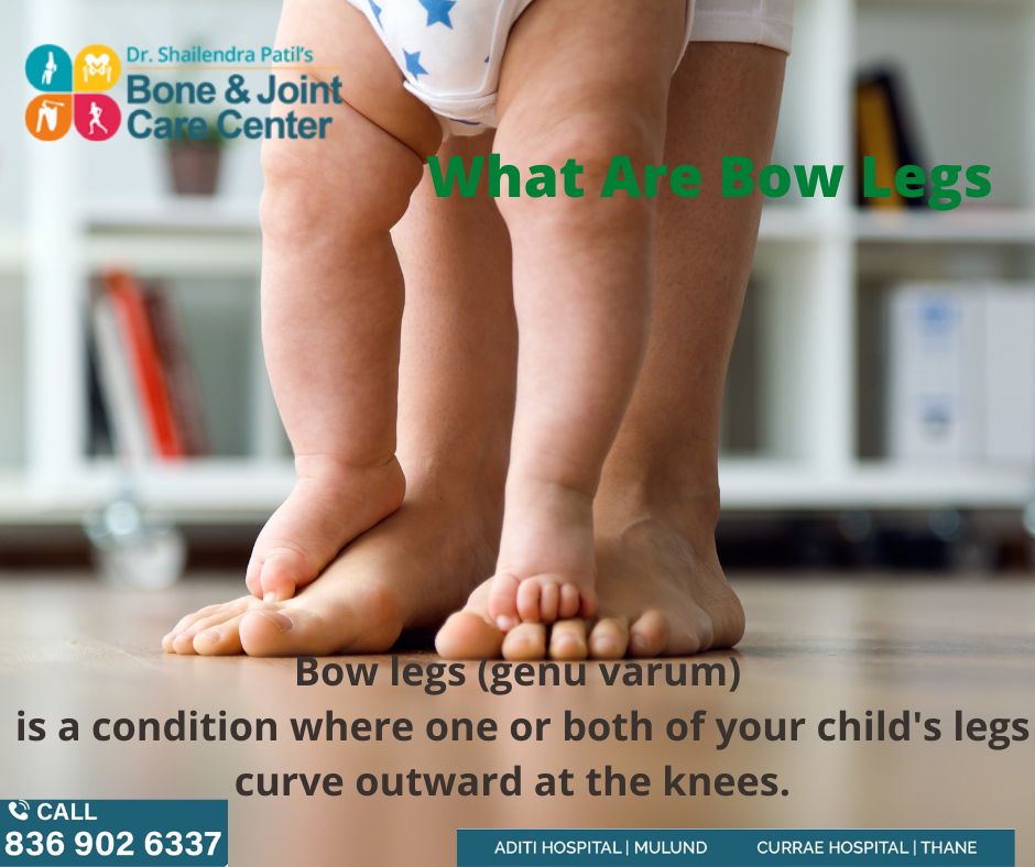 What Are Bow Legs Causes Symptoms 